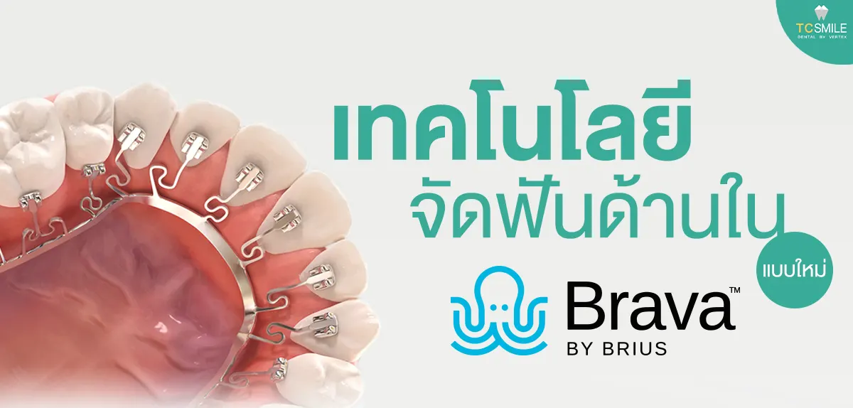 จัดฟันด้านใน Brava By Brius
